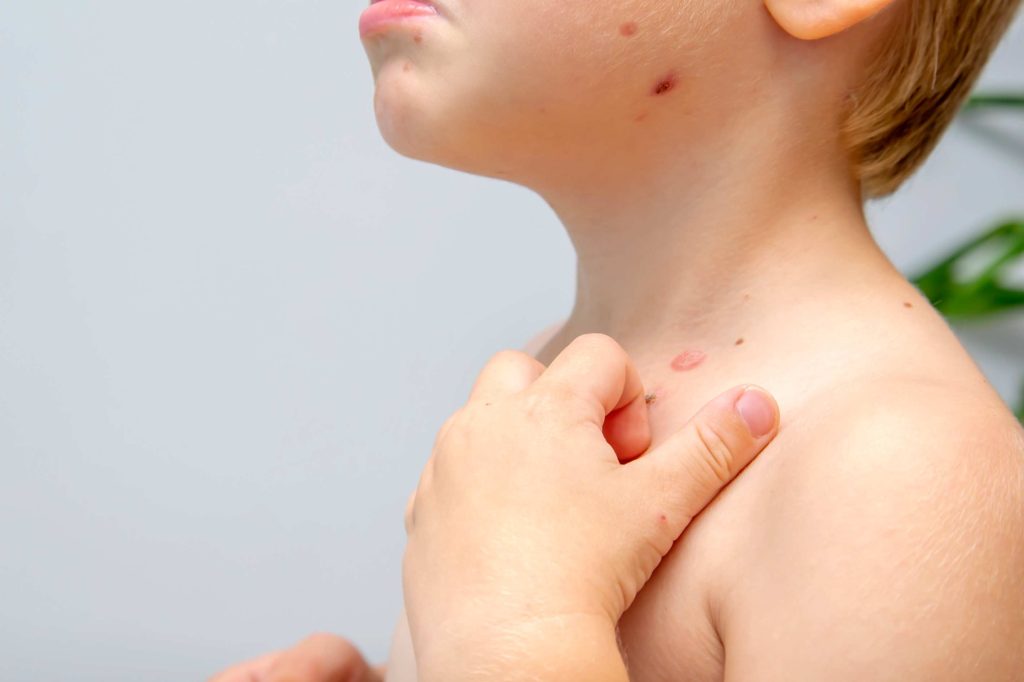 Shingles vs. Chickenpox: Causes, Symptoms & Treatment Guide